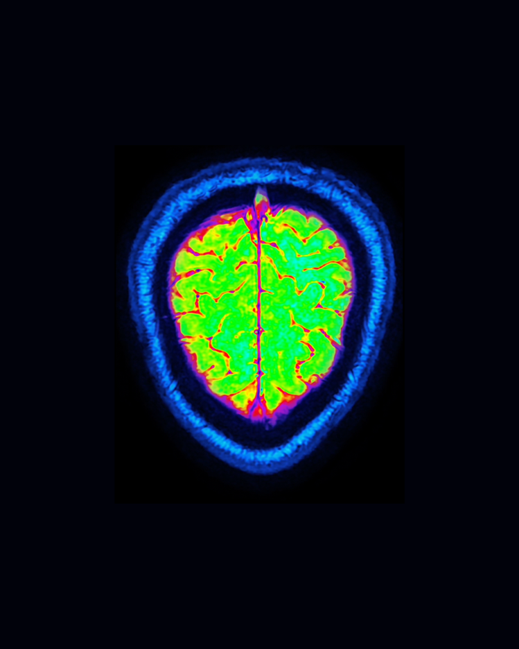 PMDD is Visible on Brain Scans – DITTO